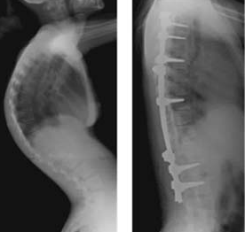 Spinal Osteotomies – Dr. Ankit Orthopedic