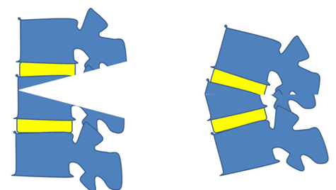 Spinal Osteotomies – Dr. Ankit Orthopedic