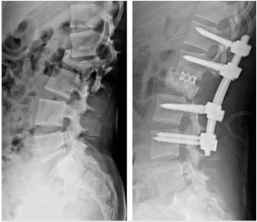 Spinal Osteotomies – Dr. Ankit Orthopedic