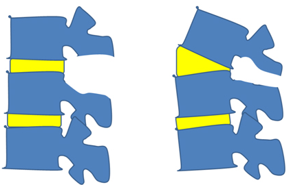 Spinal Osteotomies – Dr. Ankit Orthopedic