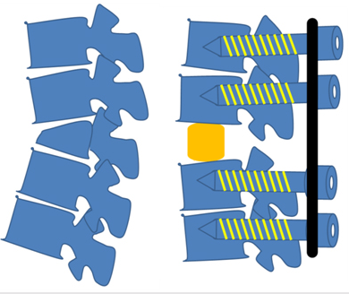 Spinal Osteotomies – Dr. Ankit Orthopedic